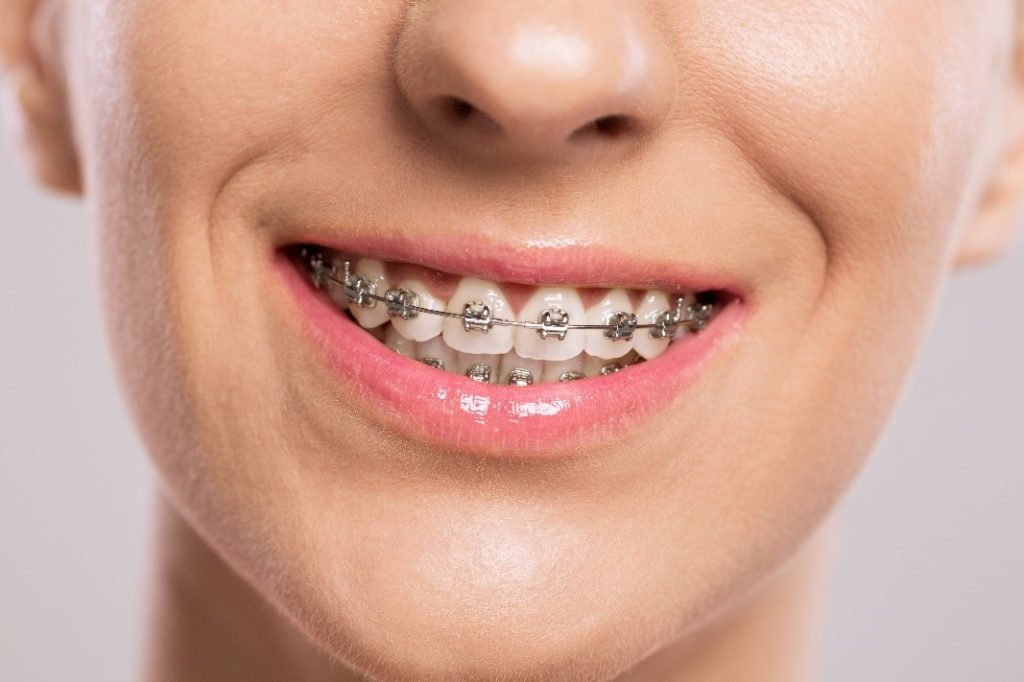 4 Tips to Help You Get the Most Out of Your Braces in Columbus, Ohio
